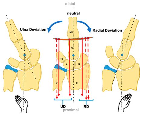 Ulnar Deviation