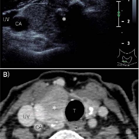 Pre Operative Imaging Findings Of Papillary Thyroid Cancer A