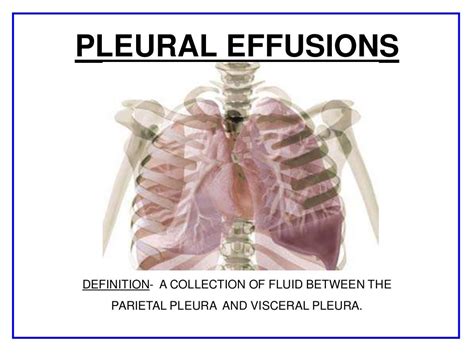 Loculated Pleural Effusion Pleural Effusion Dr Mahesh In Porn Sex Picture