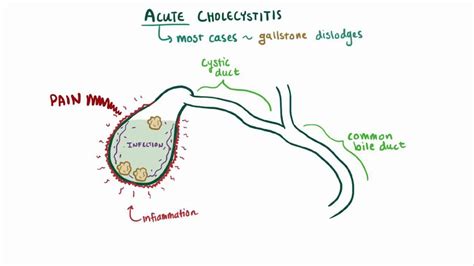 Chronic Cholecystitis Video Anatomy And Definition Osmosis