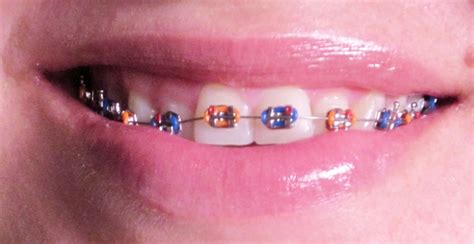Pin By Kaleb Hughes On Orthodontic Box Orthodontics Braces
