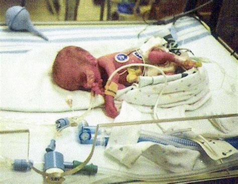 Primordial Dwarf With Identical Twin Sister Photos Abc News