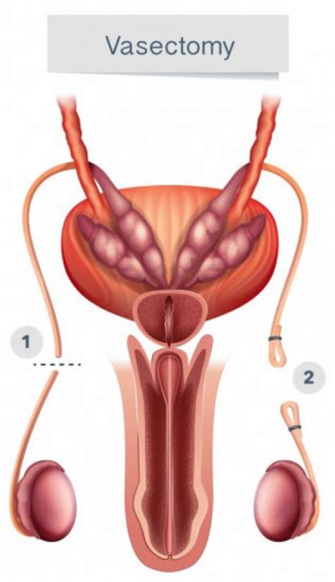 Cirurgia De Vasectomia Dr Eduardo Gerber