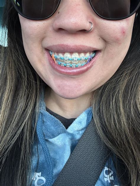 The End Is Near 7 Weeks Until These Come Off 😄 R Braces