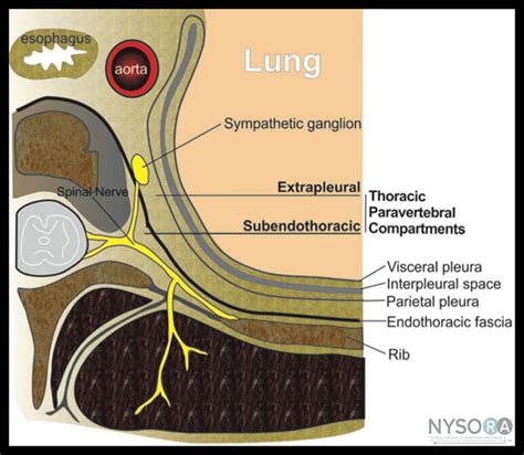 Thoracic Paravertebral Block Nysora The New York School Of Regional
