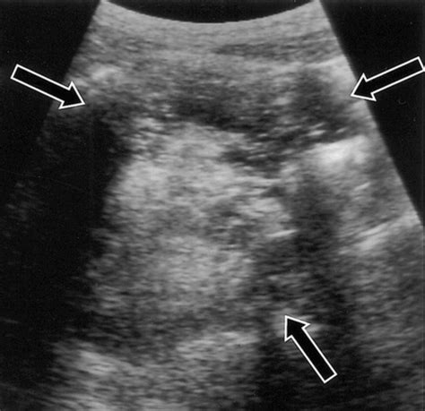 Gynecology Pelvic Ultrasound Made Easy Step By Step Guide Artofit