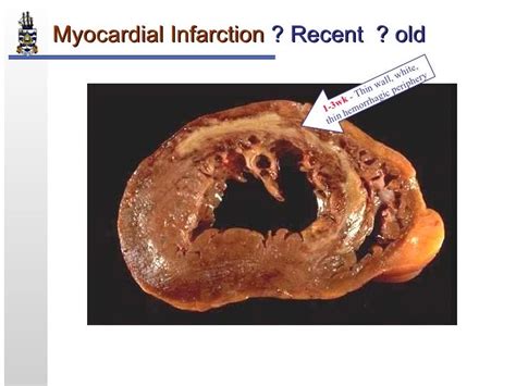 Pathology Of Acute Myocardial Infarction Overview Pat