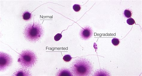 Guide To Sperm Dna Fragmentation And Testing Legacy