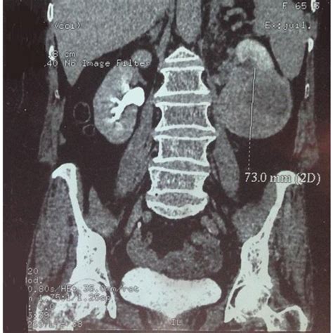Abdominal And Pelvic Computed Tomography Scan Showed The Presence Of A