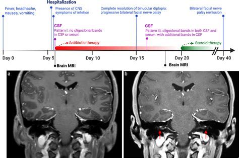 Frontiers Case Report Para Infectious Cranial Nerve Palsy After