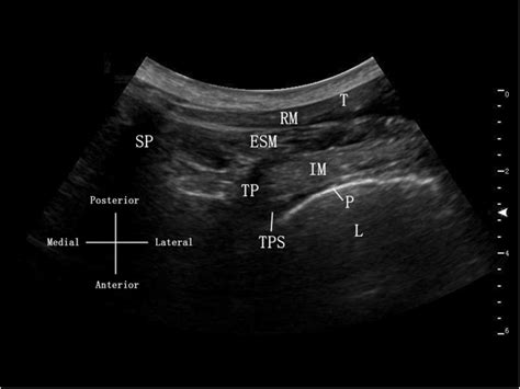 Paravertebral Block