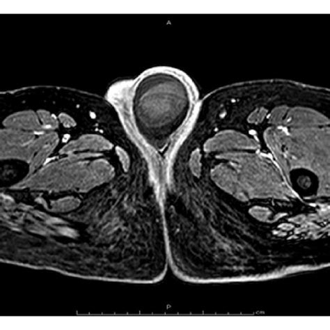 Contrast Enhanced Magnetic Resonance Imaging A No Enhancement And