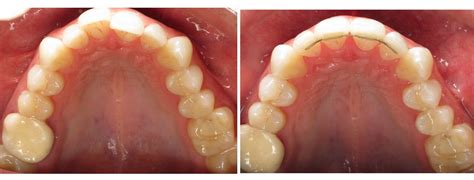 Lingual Braces