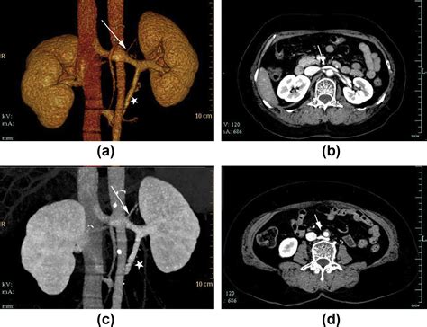 Evaluation Of Posterior Nutcracker Phenomenon Using Multisection Spiral