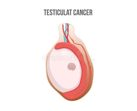 Ilustración Del Vector Del Cáncer Testicular Ilustración Del Vector