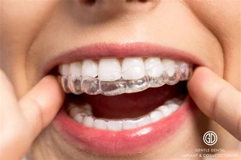 Overbite Underbite Crossbite The Gentle Dental
