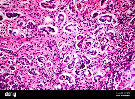 Histopathology Of Biliary Liver Cirrhosis Light Micrograph Photo