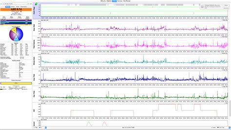 simplus ffm pulls upwards to eyes during sleep apnea board