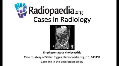 Emphysematous Cholecystitis Cases In Radiology Youtube