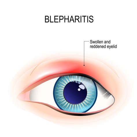 Blepharitis Health Beathealth Beat