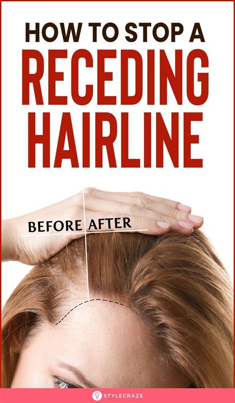 How To Stop A Receding Hairline Teenage Girl A Comprehensive Guide