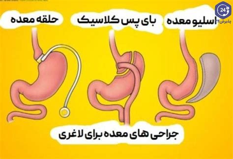 بررسی تفاوت های عمل اسلیو معده یا بای پس معده پذیرش۲۴