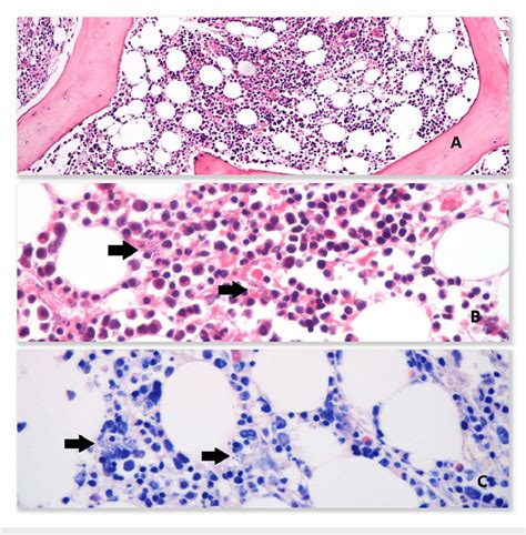 Microscopical Analysis Of The Bone Marrow That Shows Normal Cellularity