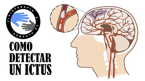 Como Detectar Un Ictus O Acv En Menos De Un Minuto Youtube