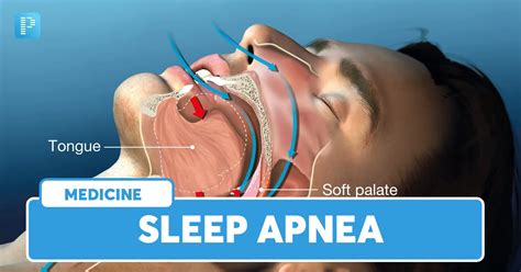 Sleep Apnea Symptoms Types Treatment And Risk Factor