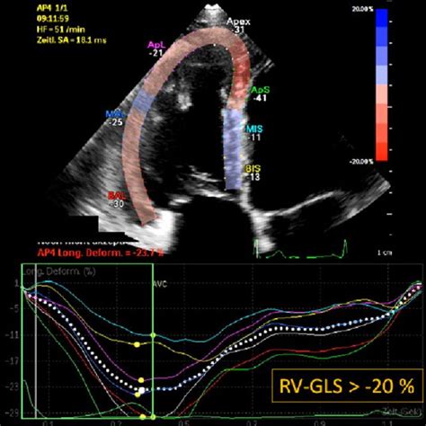 Pdf Echocardiographic Criteria For Athlete´s Heart With Cut Off