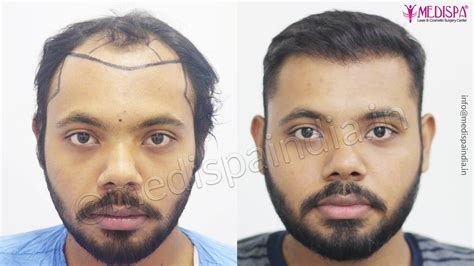 Hair Transplant Results Of Chennai Patient