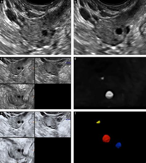 Counting Ovarian Antral Follicles By Ultrasound A Practical Guide