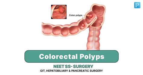Colorectal Polyps Types Neoplastic Polyps