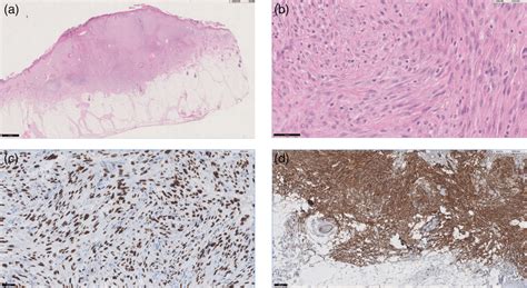 Histopathology Of Pleomorphic Dermal Sarcoma A And B Hematoxylin And