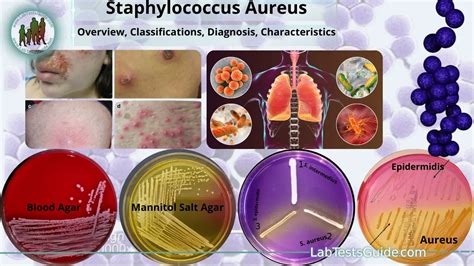 Staphylococcus Aureus