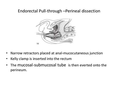 Management And Surgical Procedures Of Hirschsprung Disease
