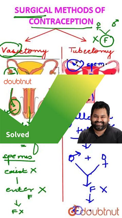 Surgical Contraception Vasectomy Vs Tubectomy