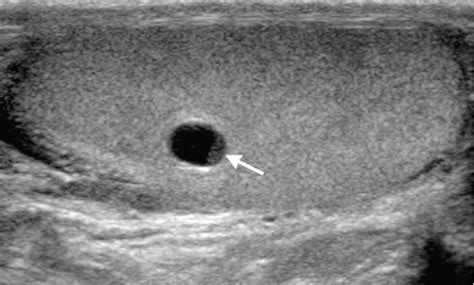 Cystic Lesions And Scrotal Fluid Collections In Adults Ultrasound