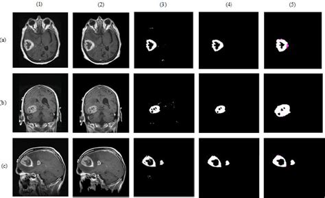 brain mr image classification based on deep features by using extreme