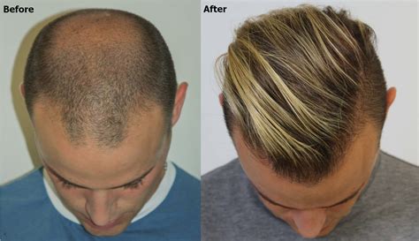 Top 156 Crown Hair Transplant Before After Polarrunningexpeditions