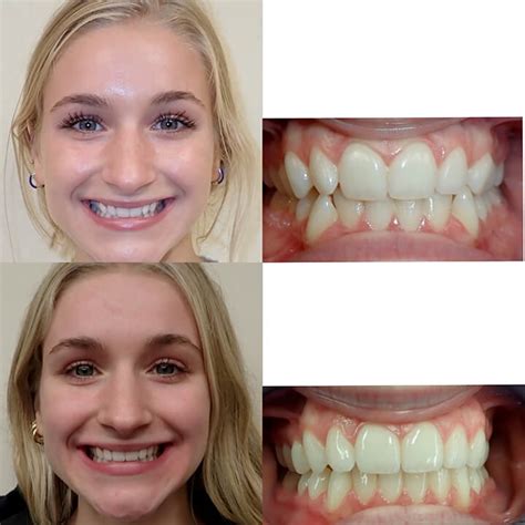 Before And After Invisalign Wazio Orthodontics