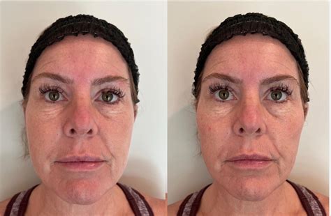 Cheek Filler Roseville Juvederm Voluma