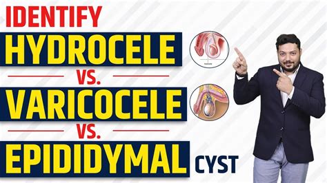 Identify Hydrocele Vs Varicocele Vs Epididymal Cyst Varicocele