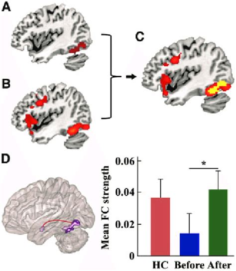 Rsfc Analyses Of Sf Subregion Of Amygdala A Whole Brain Rsfc
