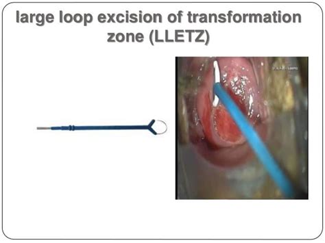 Premalignant And Malignant Conditions Of The Cervix