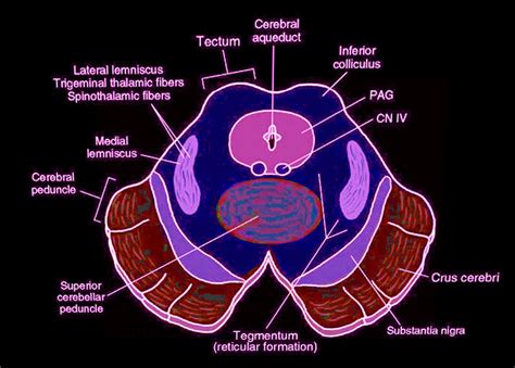 [figure Midbrain Cross Sectional Anatomy Image Courtesy S Bhimji Md