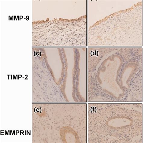 Immunostaining Of Mmp 9 Timp 2 And Emmprin Expression In