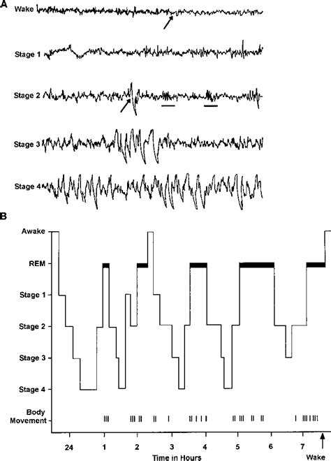 Normal Eeg Patterns