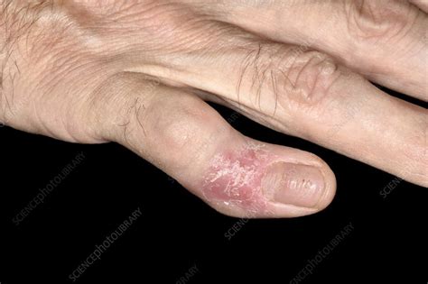Psoriatic Arthritis Of The Hands Stock Image C047 8474 Science