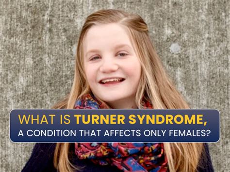 Turner Syndrome Causes Symptoms Complications And Treatments